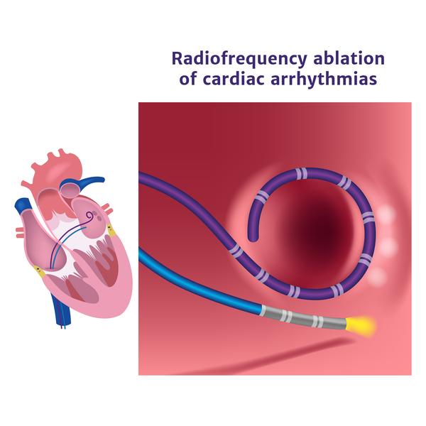 Ablation Catheter Manufacturers Race to the Micro | Better Dispensing Blog | Nordson EFD